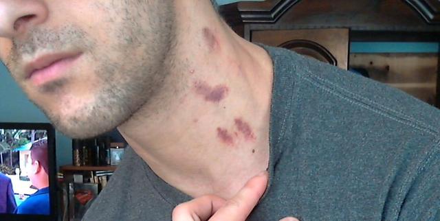 7 Facts About Hickeys You Probably Don't Know