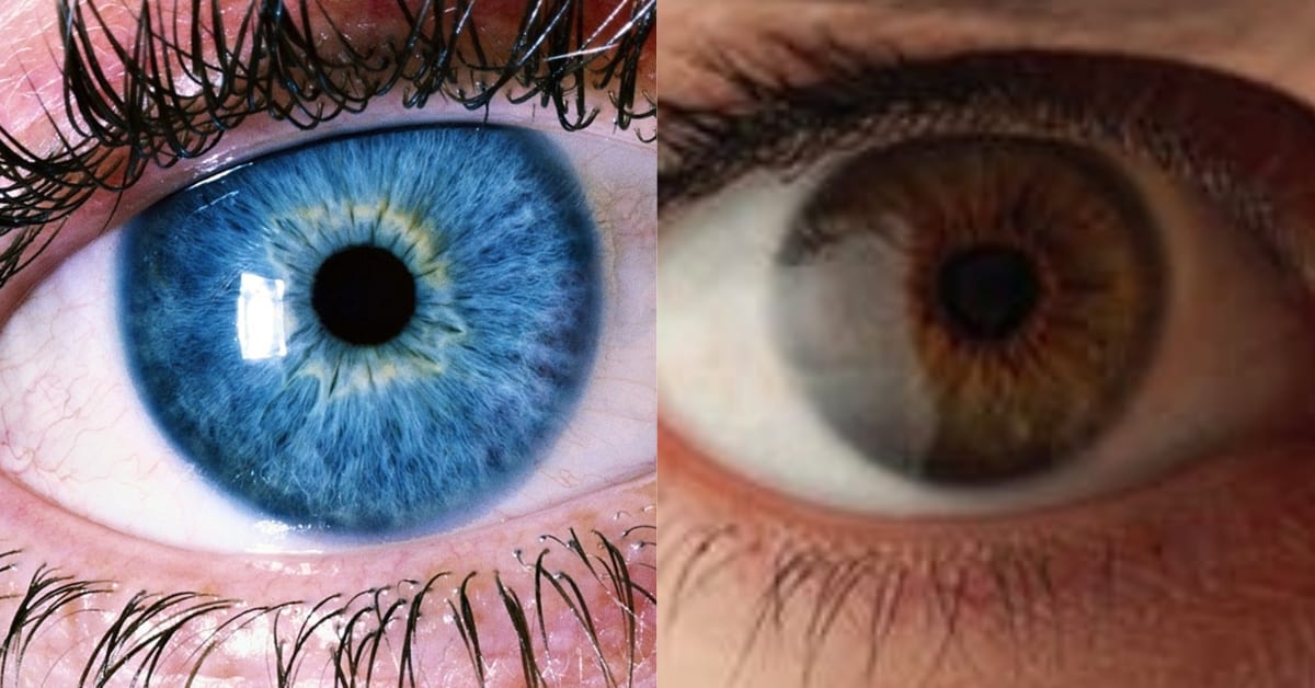 Researchers Discover Your Eye Color May Make You More Susceptible to ...