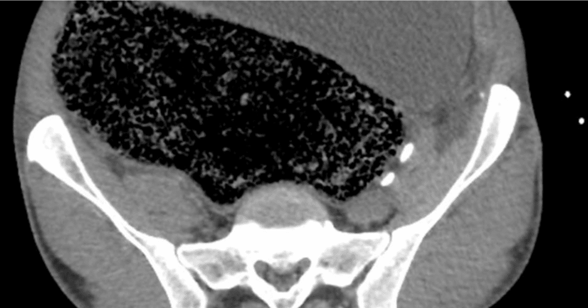This Man's Ginormous Poop Nearly Killed Him