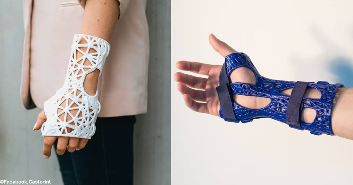These 3D Printed Casts Could Be the Future of Healthcare
